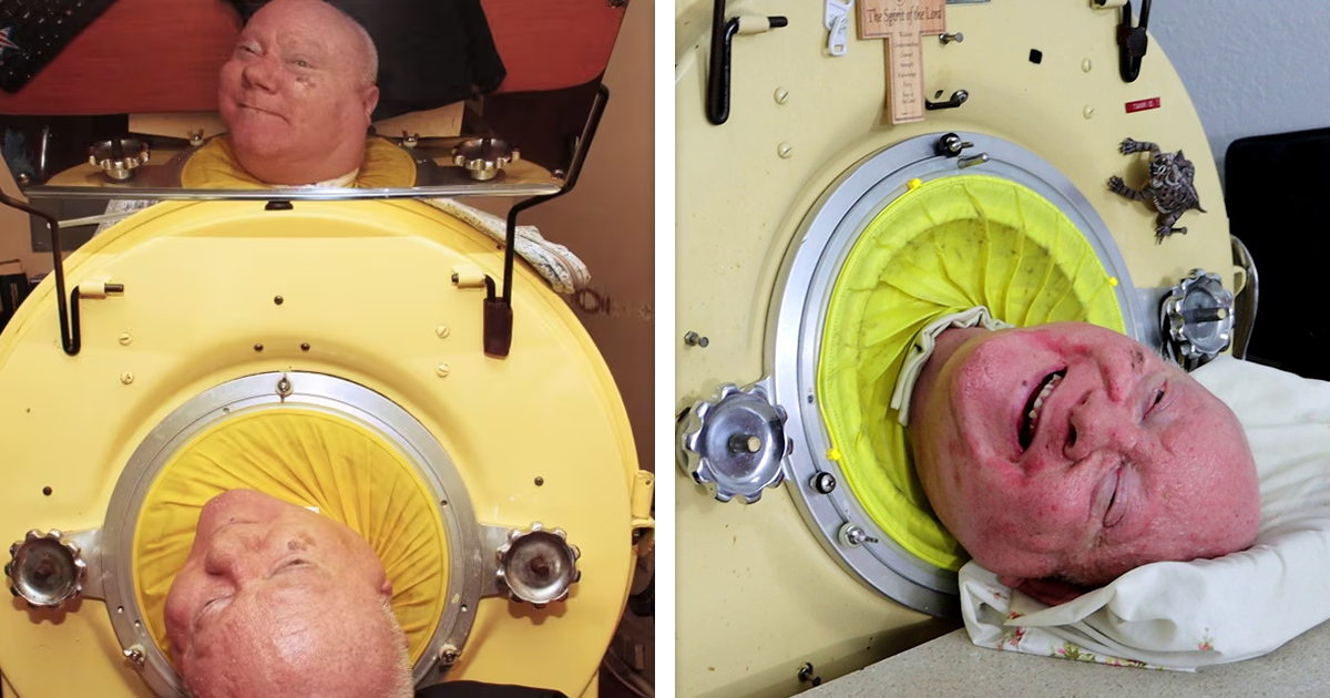 Zomrel jeden z posledných používateľov stroja železné pľúca - Emefka.sk